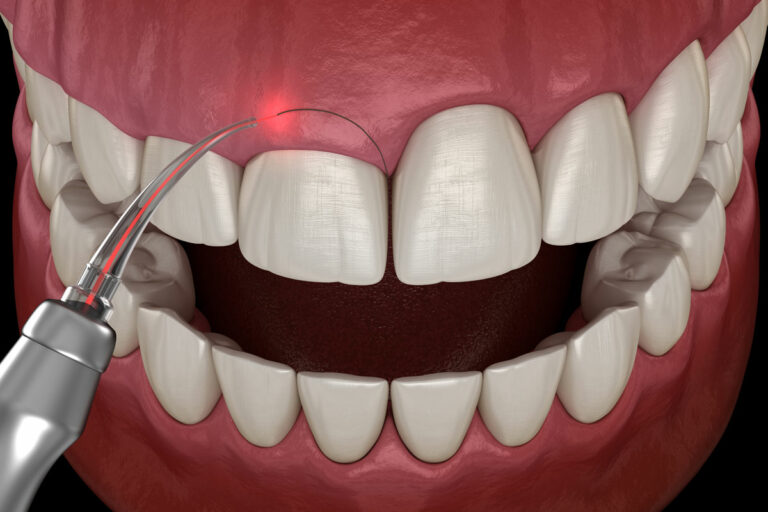 Gemini Laser: A Groundbreaking Instrument for Contemporary Dentistry ...